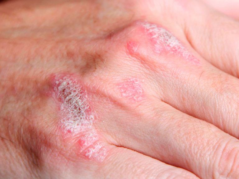 Psoriasis: síntomas y causas | Farmacia López Ruiz Cátedra